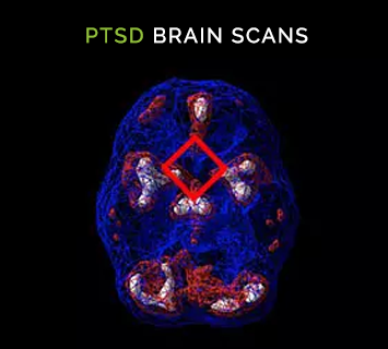 PTSD