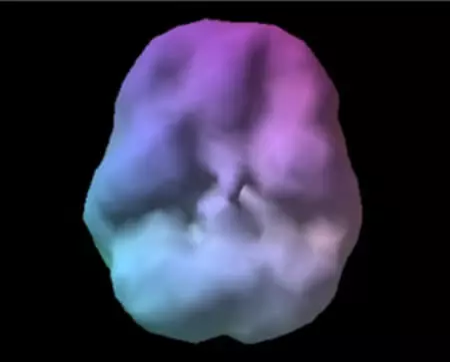 How Does SPECT Differ from Other Brain Scans? | Amen Clinics